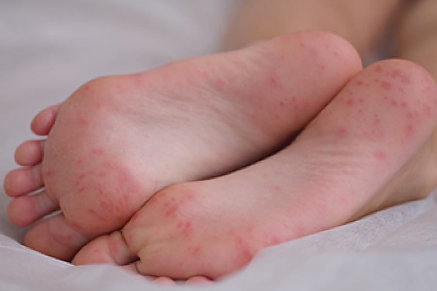 Managing Your Non-Diabetic Foot Infection